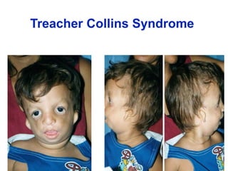 Intellectual Disability-Brachydactyly-Pierre Robin Syndrome – PJLM