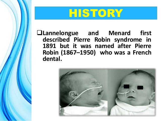 Pierre Robin Syndrome