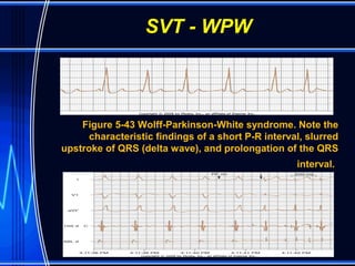 PEDIATRIC DYSRHYTHMIA 2015 | PPT