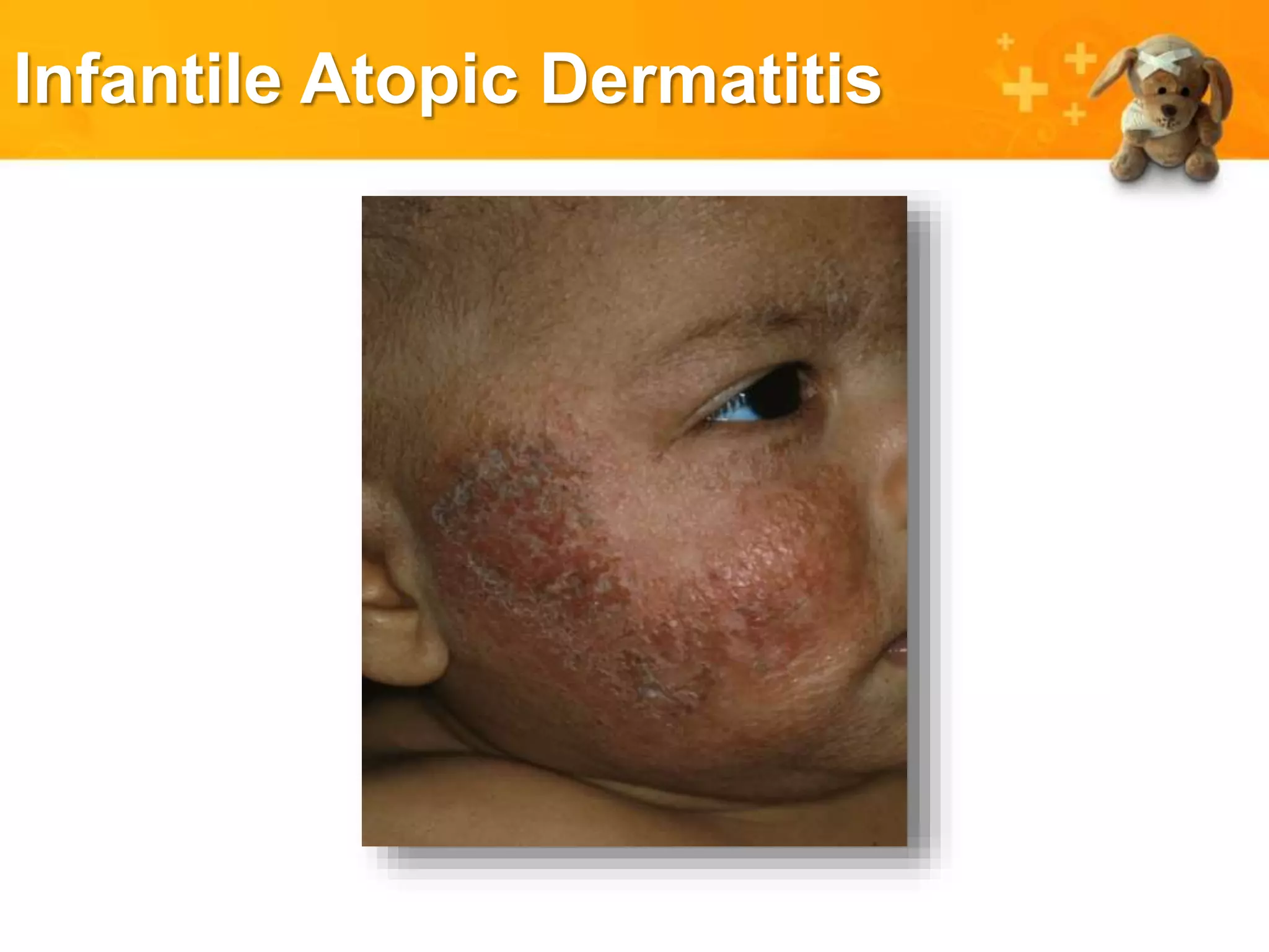 Common pediatric skin rash | PPTX