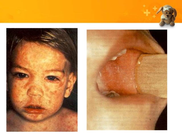 Common pediatric skin rash | PPTX | Infectious Diseases | Diseases and ...