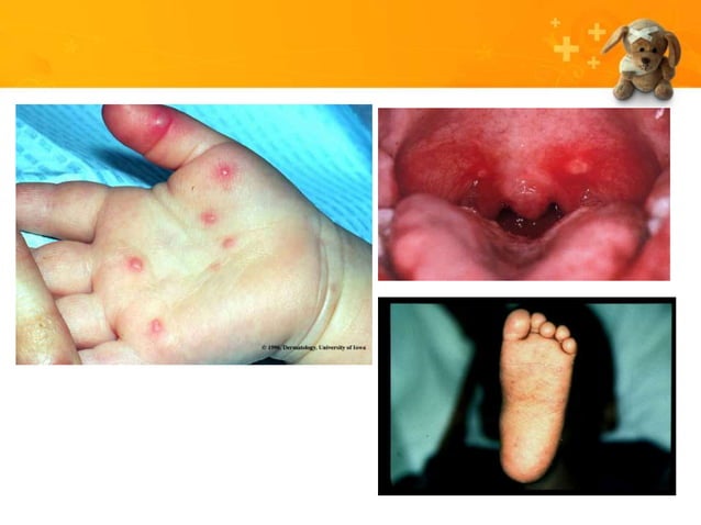 Common pediatric skin rash