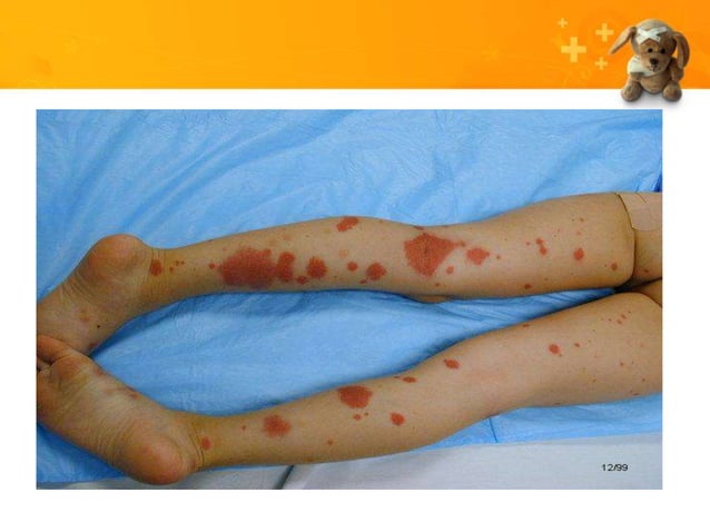Common pediatric skin rash