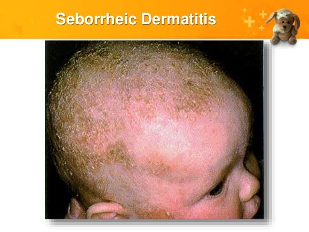 Common pediatric skin rash