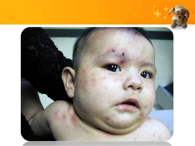 Common pediatric skin rash