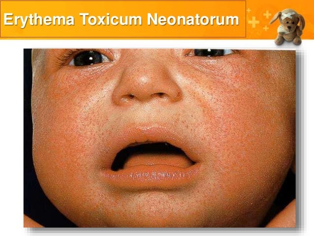 Common pediatric skin rash