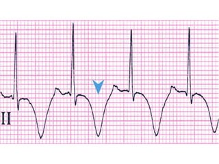 Cardiopulmonary dysfunction in SAH | PPT