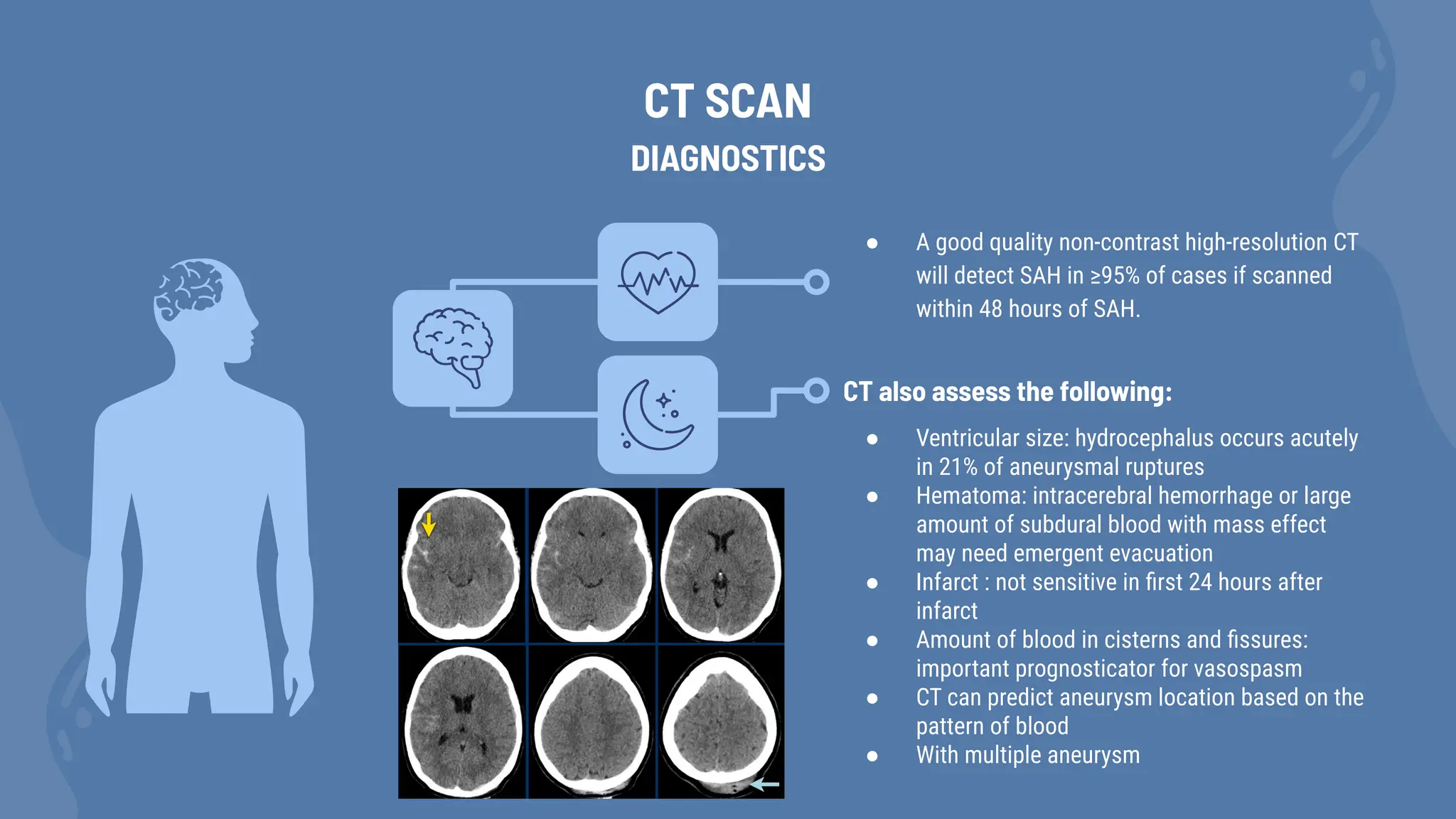 Lecture on Subarachnoid Hemorrhage (Surgery) | PDF