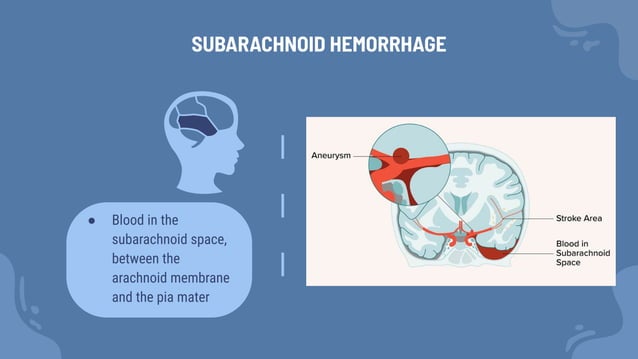 Lecture on Subarachnoid Hemorrhage (Surgery) | PPT