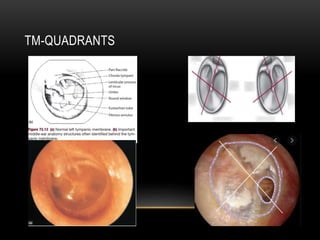 Tympanic Membrane Exam Slidesho