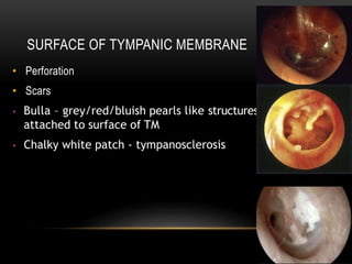 Tympanic Membrane Perforation Scar
