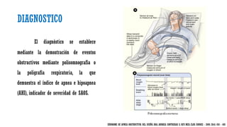 Síndrome de Apnea Hipopnea obstructiva del Sueño Dr. Barramuño | PDF