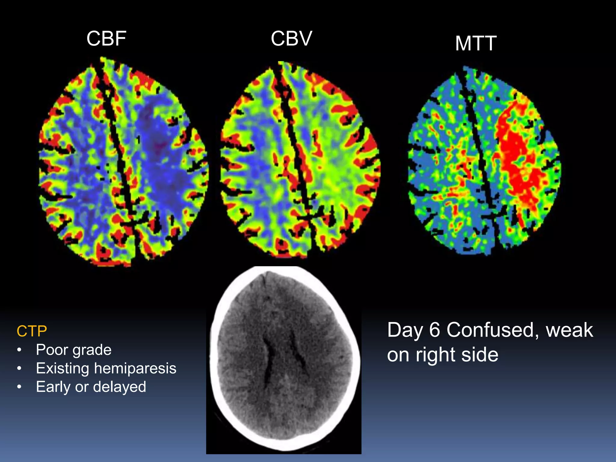 Management of SAH | PPTX | Blood Disorders | Diseases and Conditions