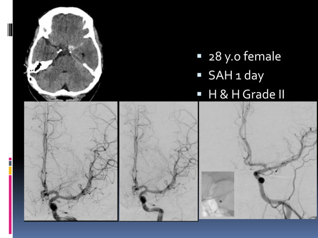 Management of SAH | PPTX | Blood Disorders | Diseases and Conditions