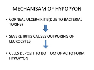 HYPOPYON CORNEAL ULCER | PPTX