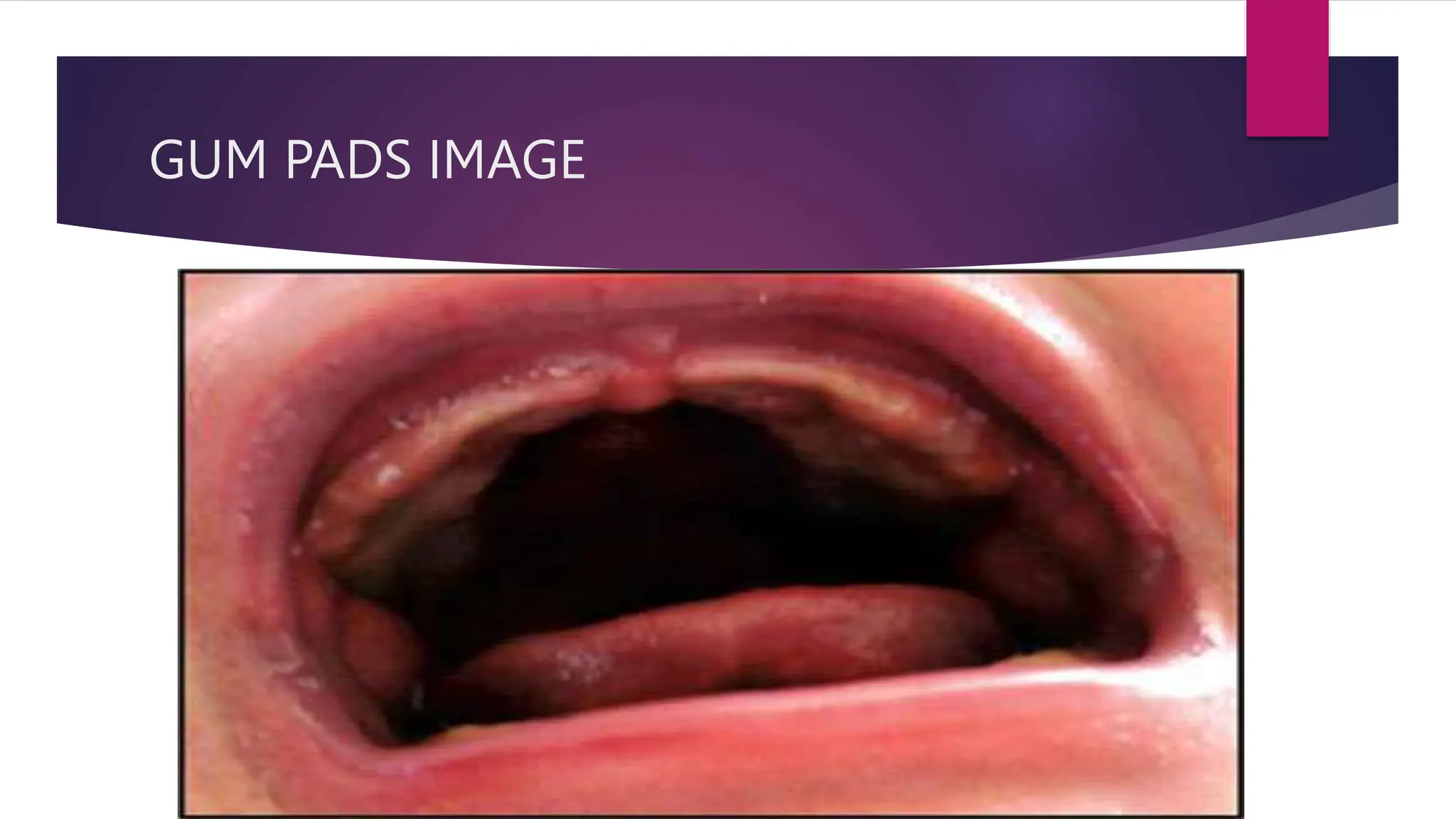 DEVELOPMENT OF OCCLUSION IN PEDIATRIC DENTISTRY | PPTX