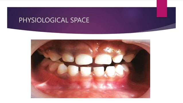 DEVELOPMENT OF OCCLUSION IN PEDIATRIC DENTISTRY | PPTX | Dental Health ...
