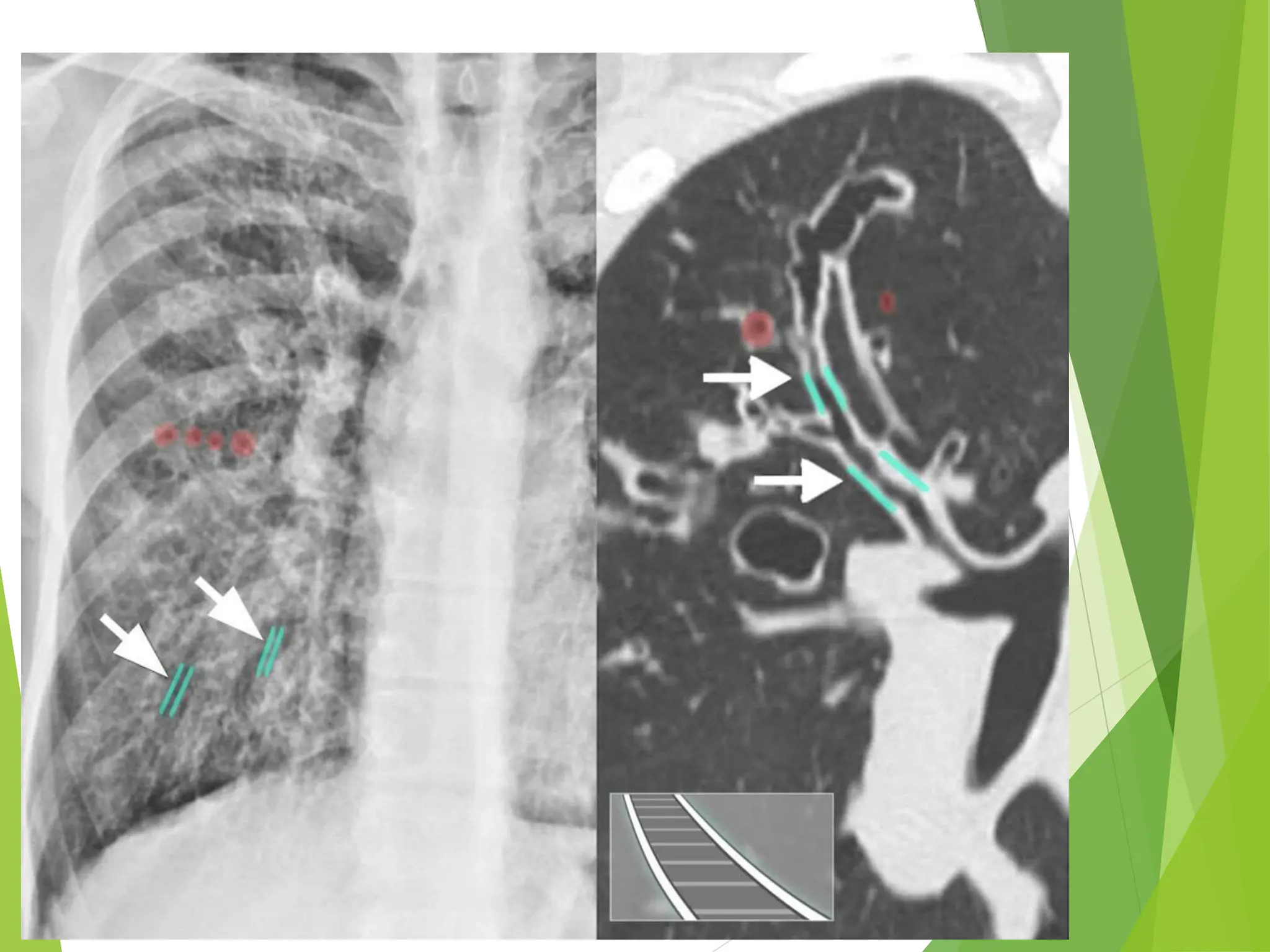 Diagnosis and Imaging of Bronchiectasis.ppt