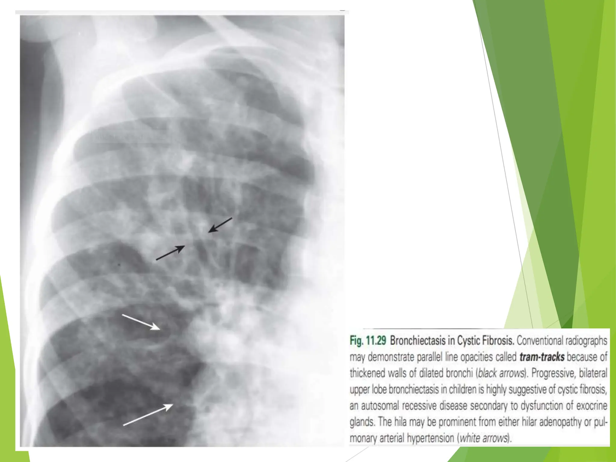 Diagnosis and Imaging of Bronchiectasis.ppt