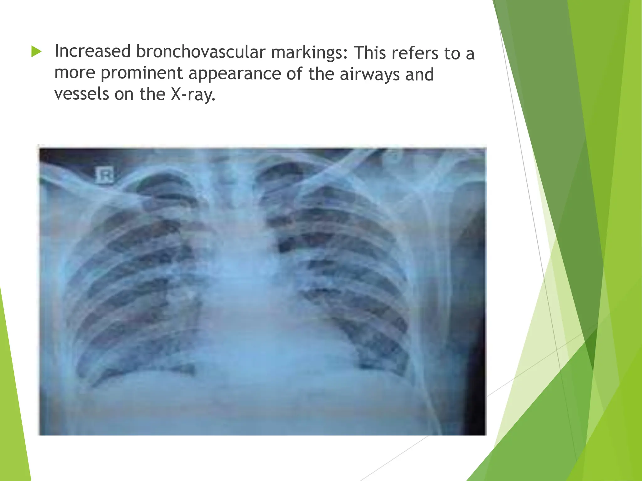 Diagnosis and Imaging of Bronchiectasis.ppt