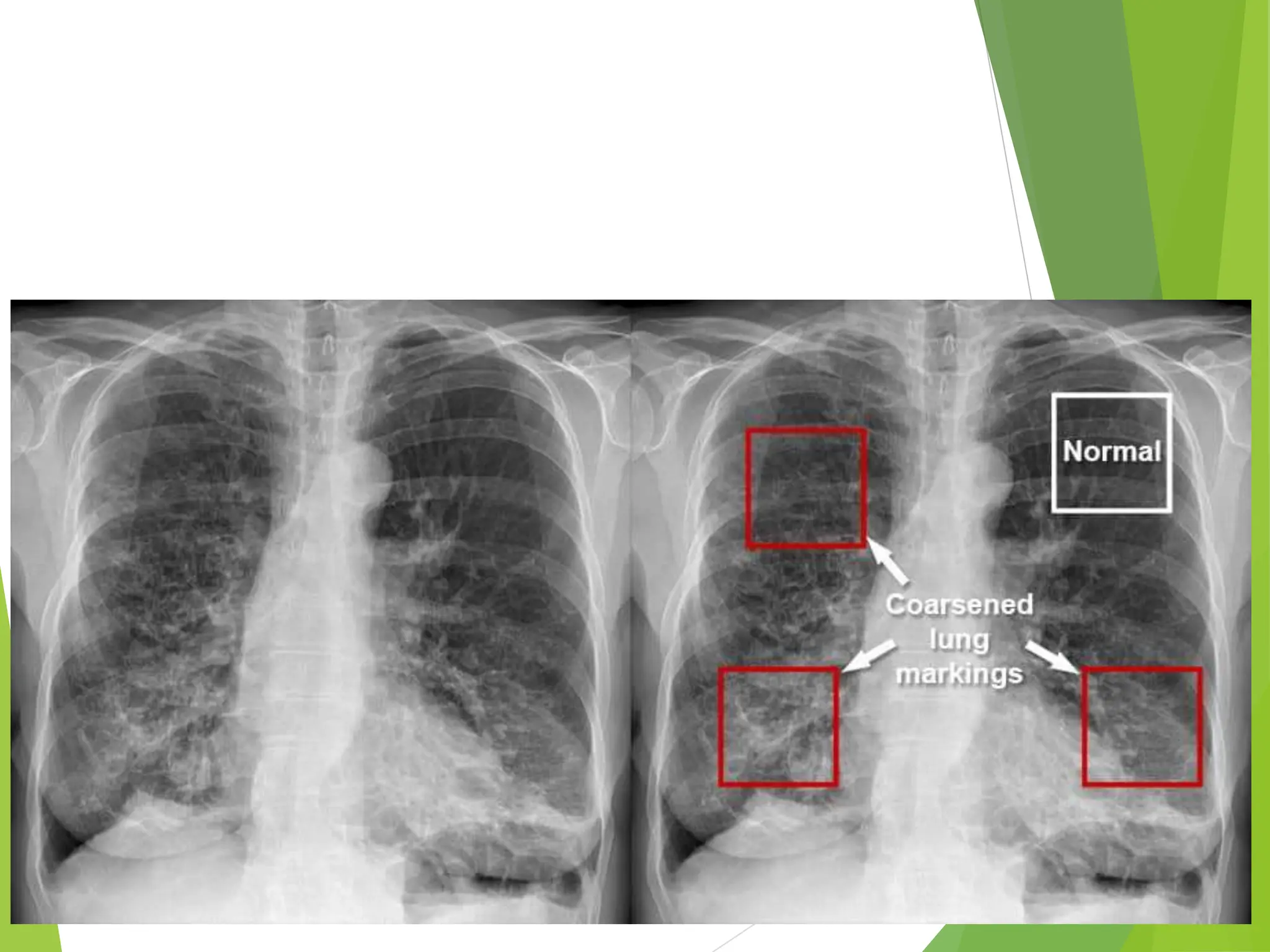 Diagnosis and Imaging of Bronchiectasis.ppt