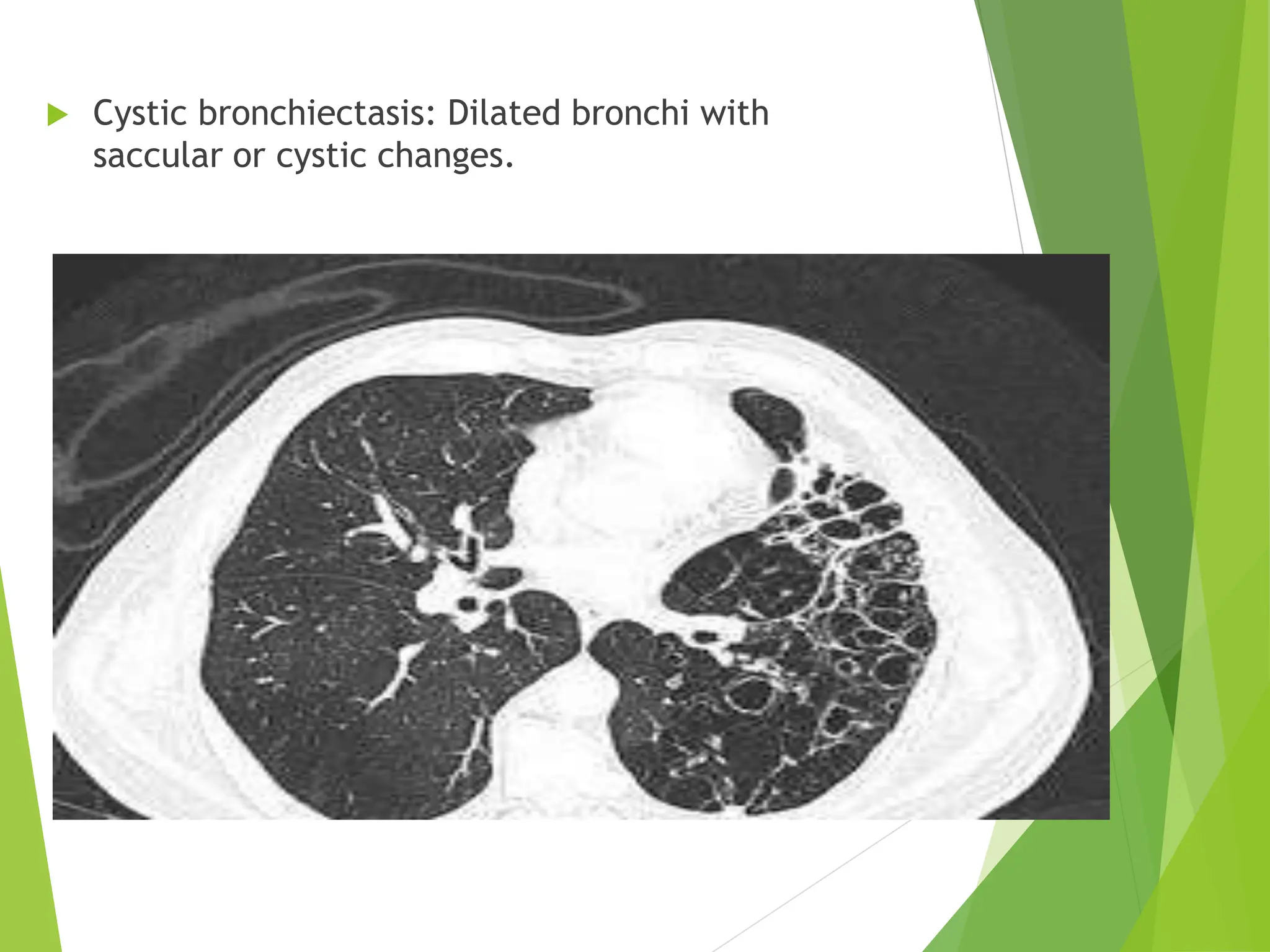 Diagnosis and Imaging of Bronchiectasis.ppt
