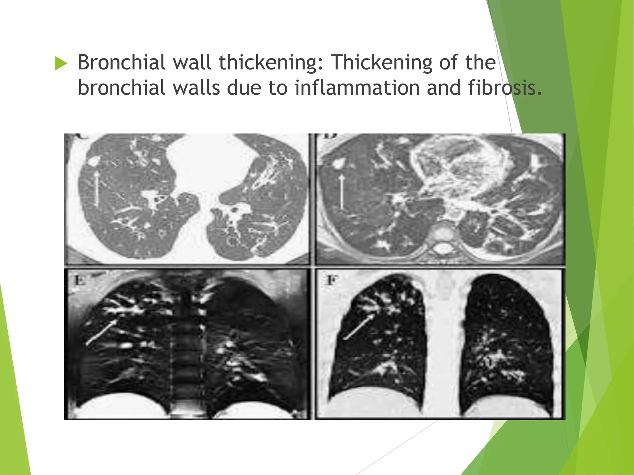 Diagnosis and Imaging of Bronchiectasis.ppt