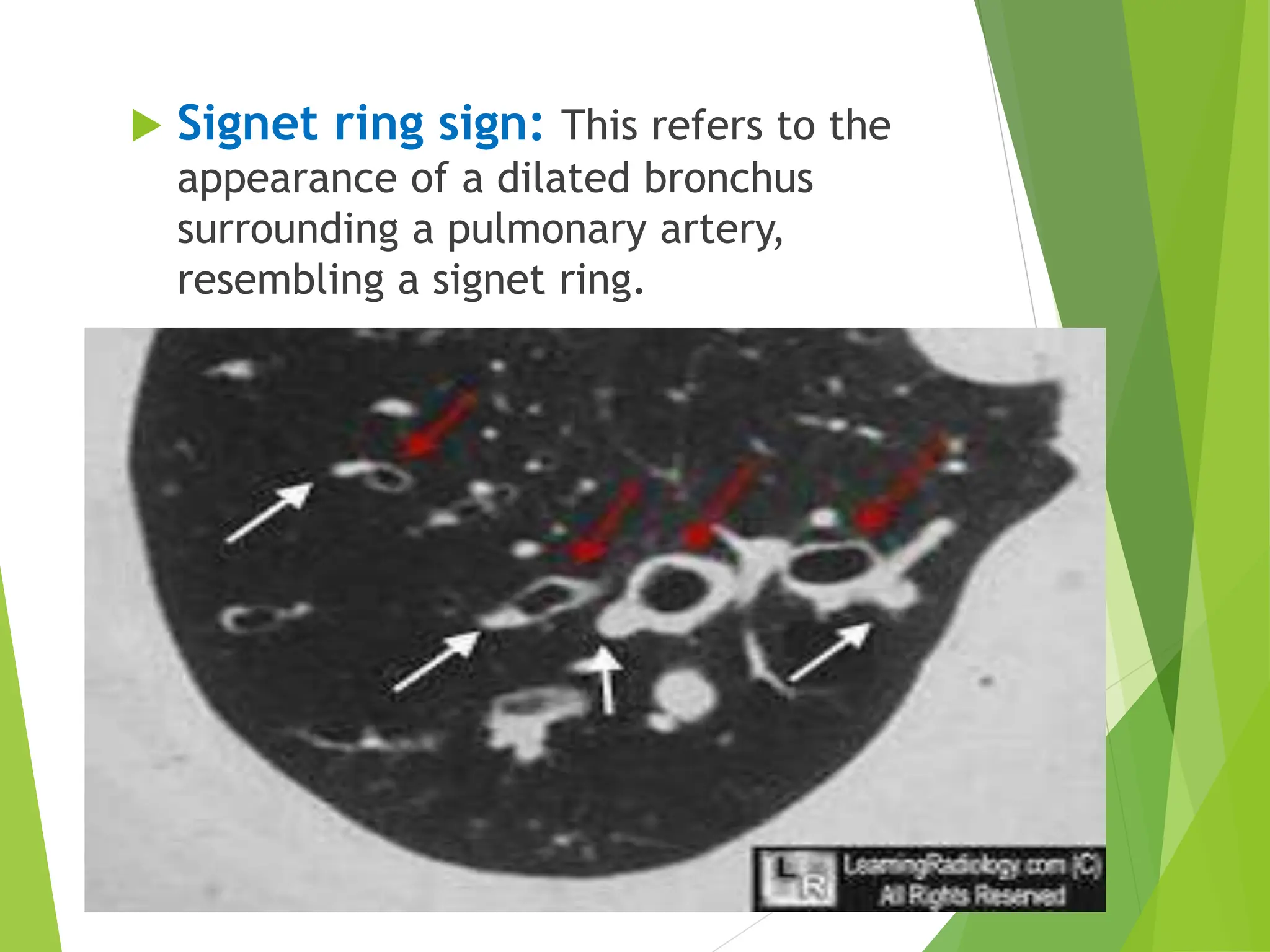 Diagnosis and Imaging of Bronchiectasis.ppt