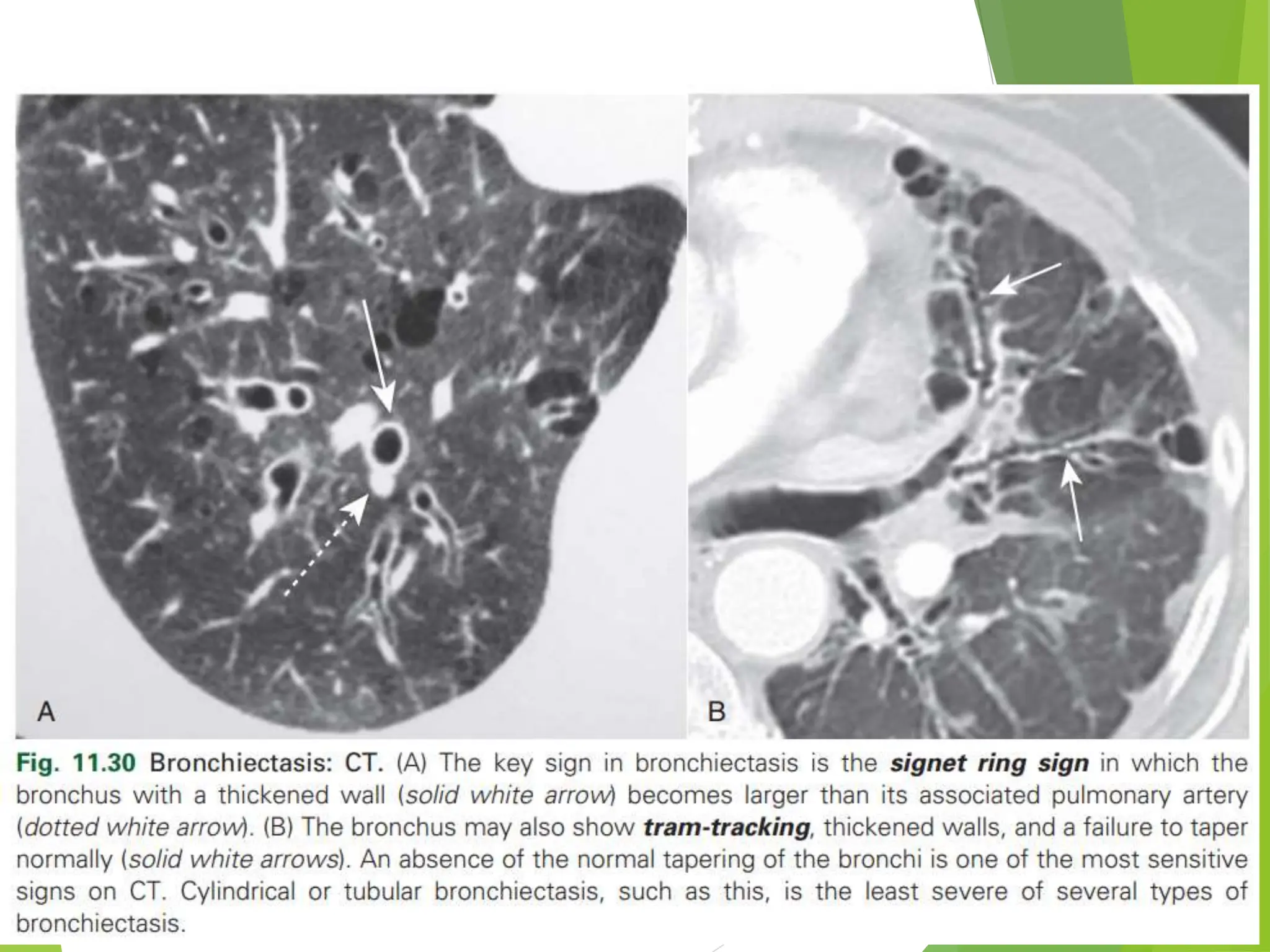 Diagnosis and Imaging of Bronchiectasis.ppt
