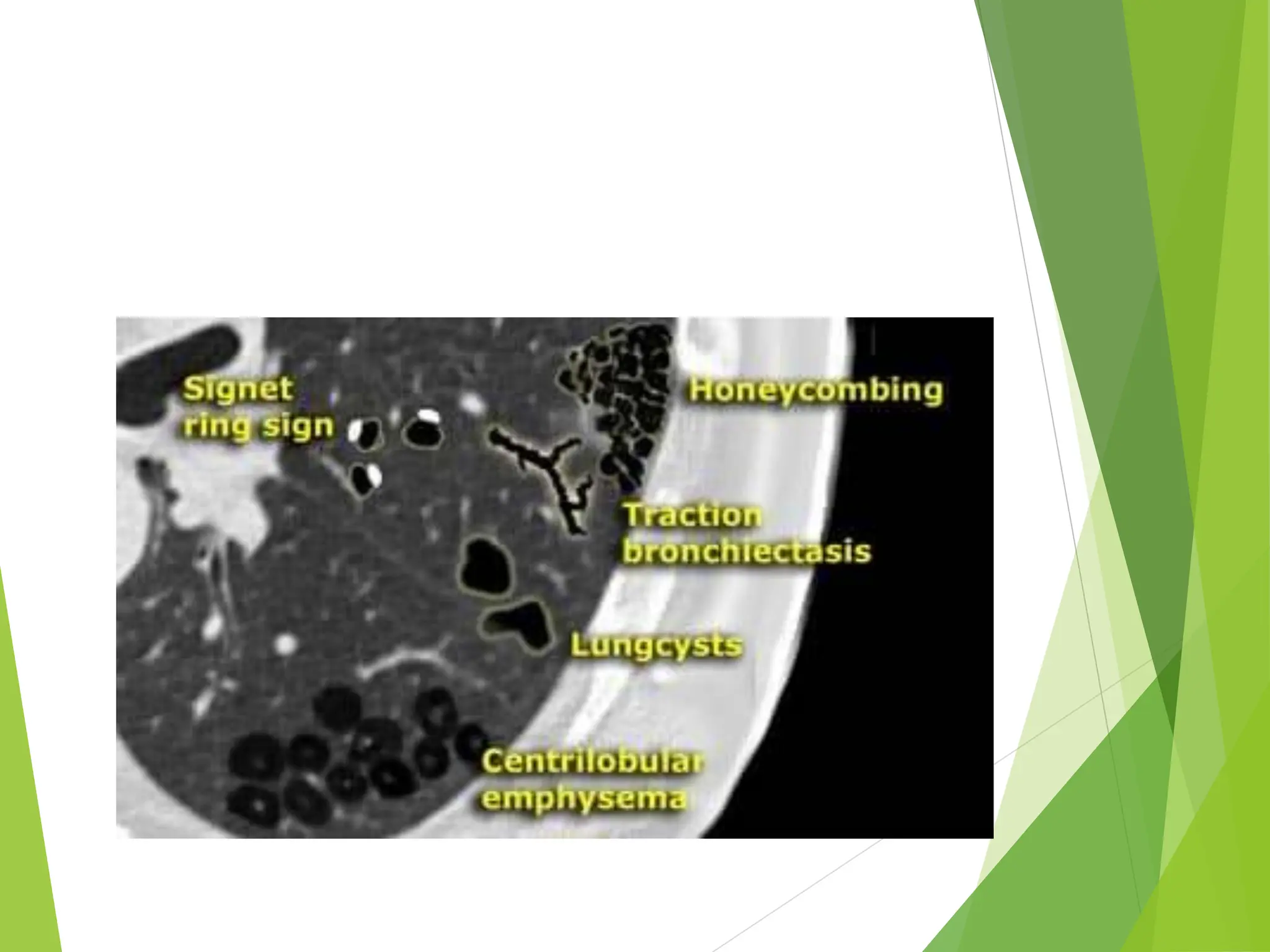 Diagnosis and Imaging of Bronchiectasis.ppt
