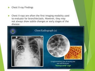 Diagnosis and Imaging of Bronchiectasis.ppt | Lung and Respiratory ...
