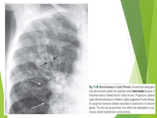 Diagnosis and Imaging of Bronchiectasis.ppt
