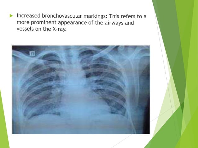 Diagnosis and Imaging of Bronchiectasis.ppt | Lung and Respiratory ...