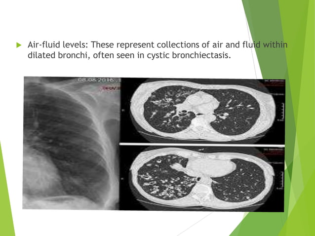Diagnosis and Imaging of Bronchiectasis.ppt | Lung and Respiratory ...