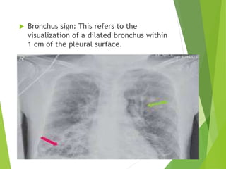 Diagnosis and Imaging of Bronchiectasis.ppt | Lung and Respiratory ...
