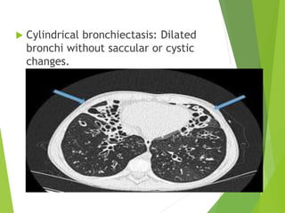 Diagnosis and Imaging of Bronchiectasis.ppt