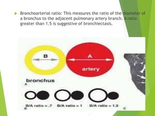 Diagnosis and Imaging of Bronchiectasis.ppt
