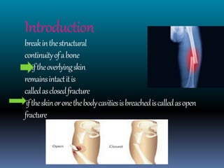 Fractures | PPTX