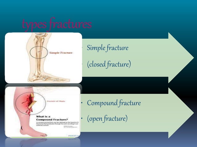 Fractures | PPT