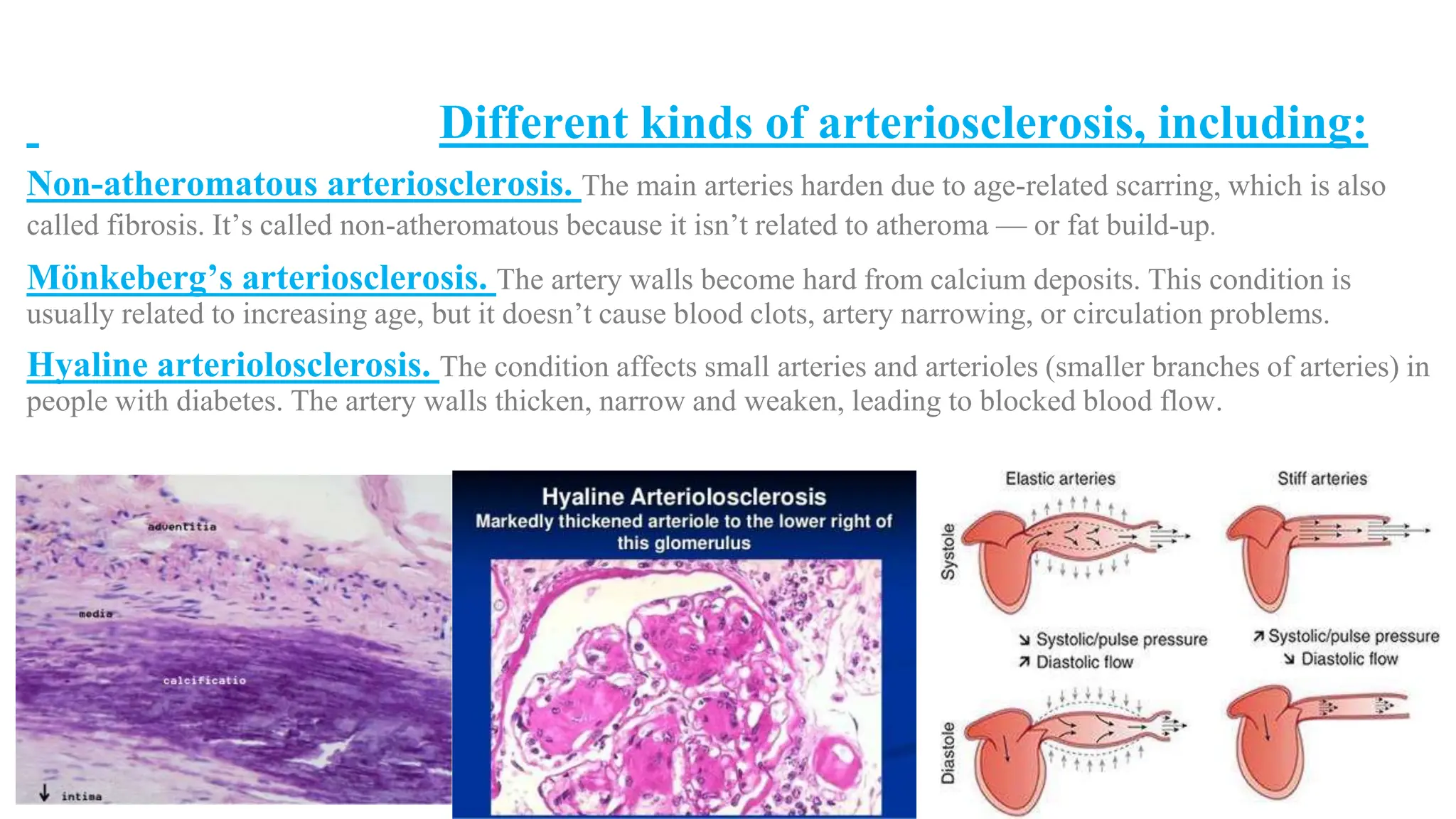 Arteriosclerosis Ppt