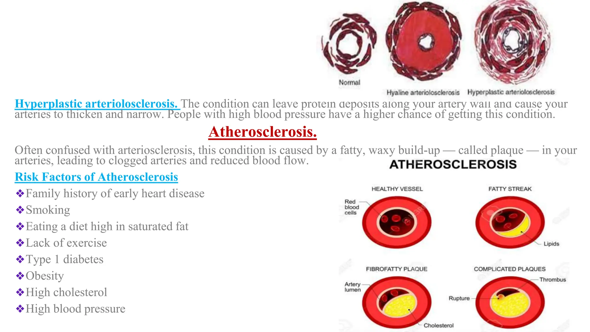 Arteriosclerosis | PPTX