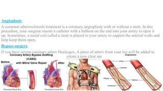 Arteriosclerosis | PPT