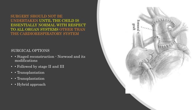 Left heart Hypoplasia.pptx