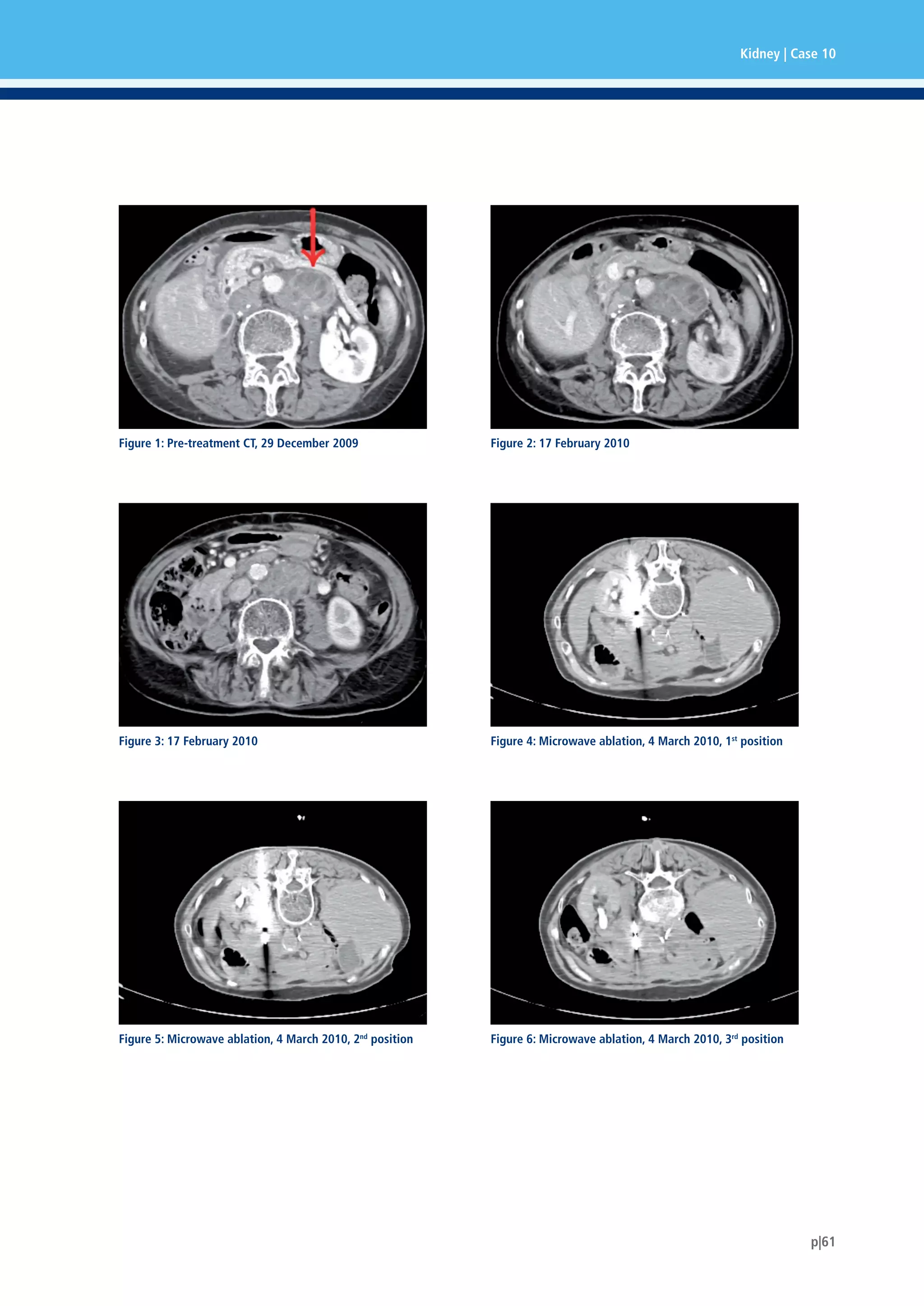 Microwave Ablation: Case Report | PDF