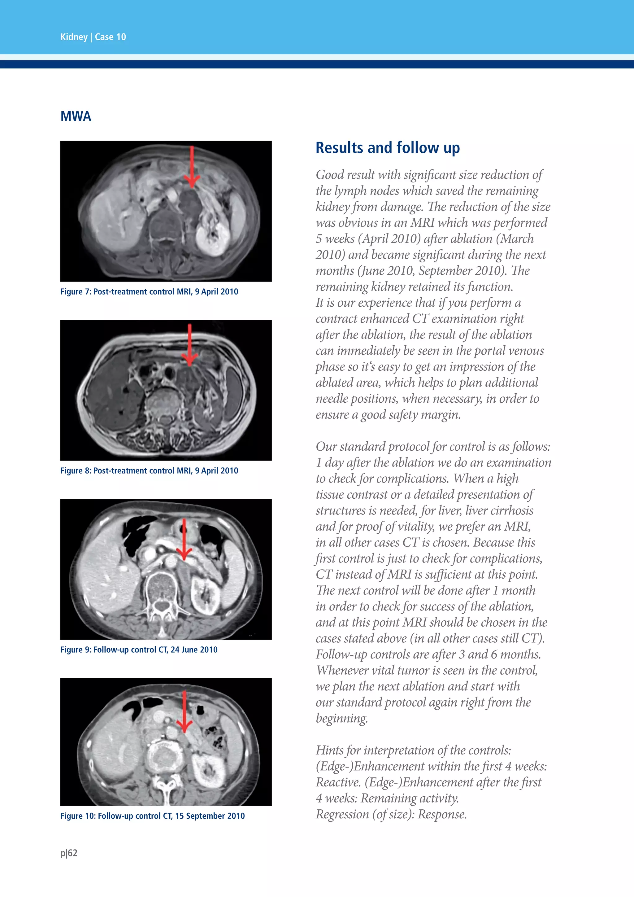 Microwave Ablation: Case Report | PDF