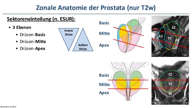 MRT der Prostata – welche Technik, wie geht PI-RADS?