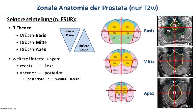 MRT der Prostata – welche Technik, wie geht PI-RADS?