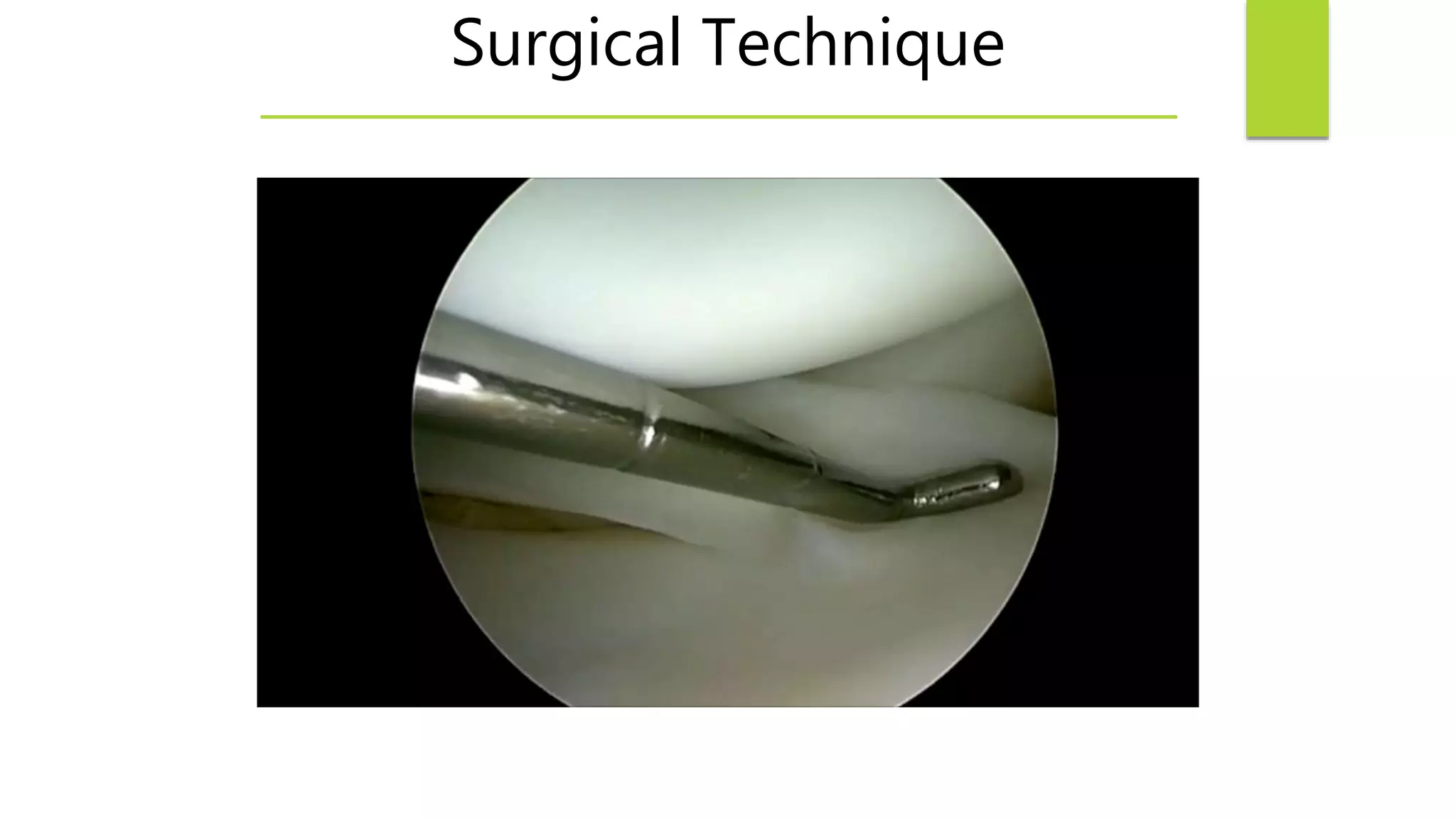 Popliteus is a safe location for all-inside meniscal repair devices in ...