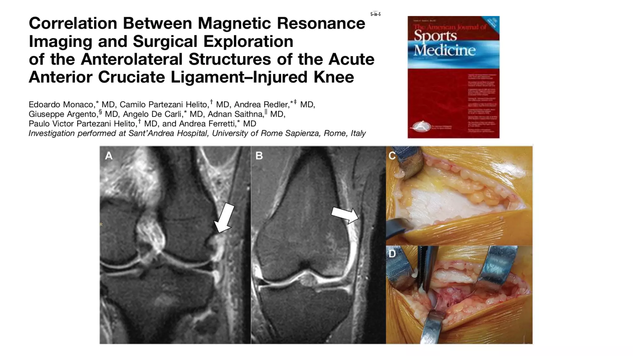 Combined ACL and Anterolateral Ligament Reconstruction in Professional ...