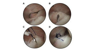 Ramp lesions in the ACL-Injured Knee | PPTX